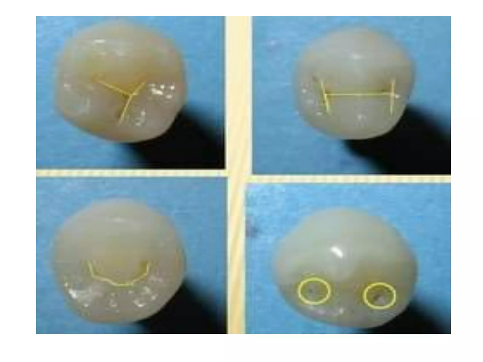 Mandibular 2nd premolar | PPTX