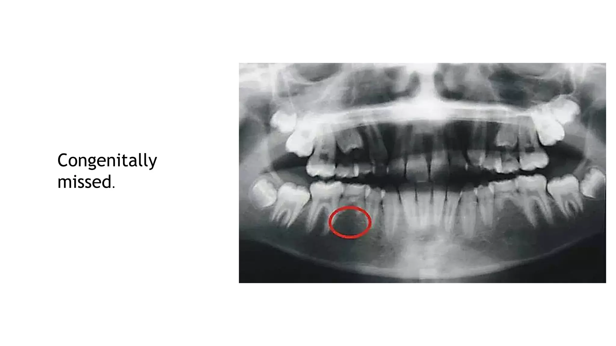 Mandibular 2nd premolars | PPTX