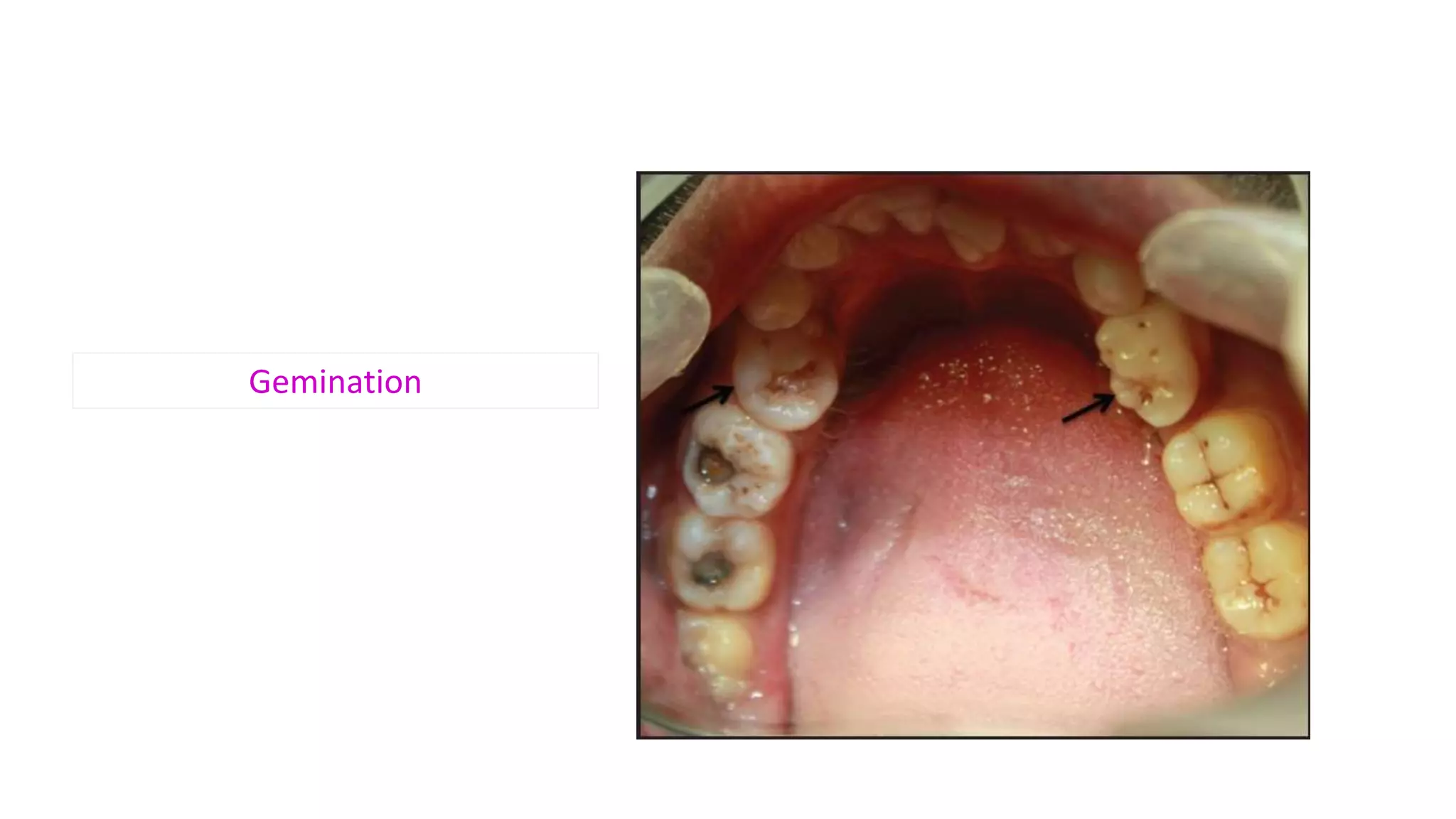 Mandibular 2nd premolars | PPTX