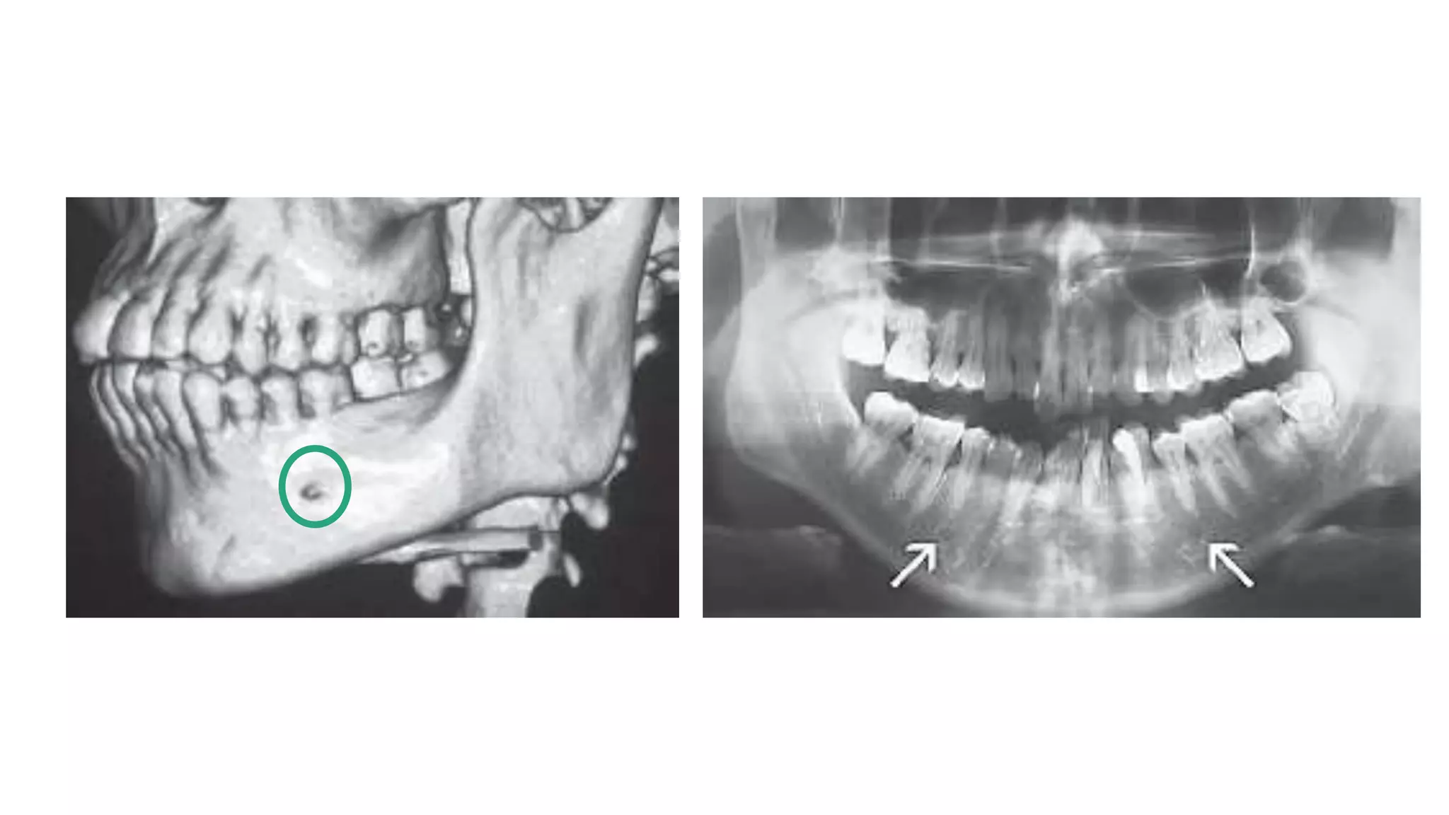 Mandibular 2nd premolars | PPTX