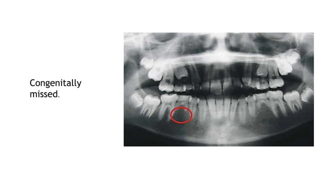 Mandibular 2nd premolars | PPTX