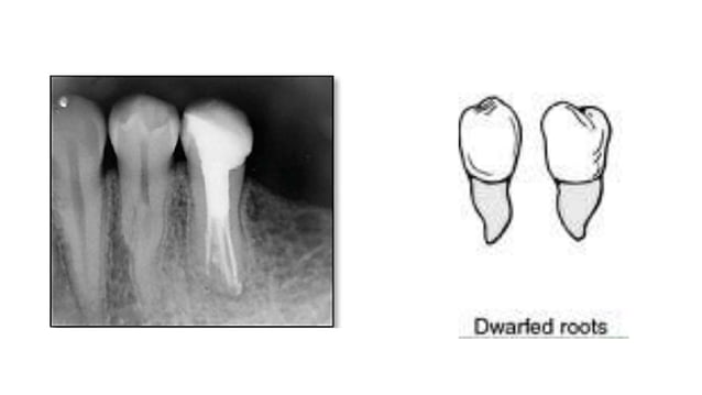 Mandibular 2nd premolars | PPTX