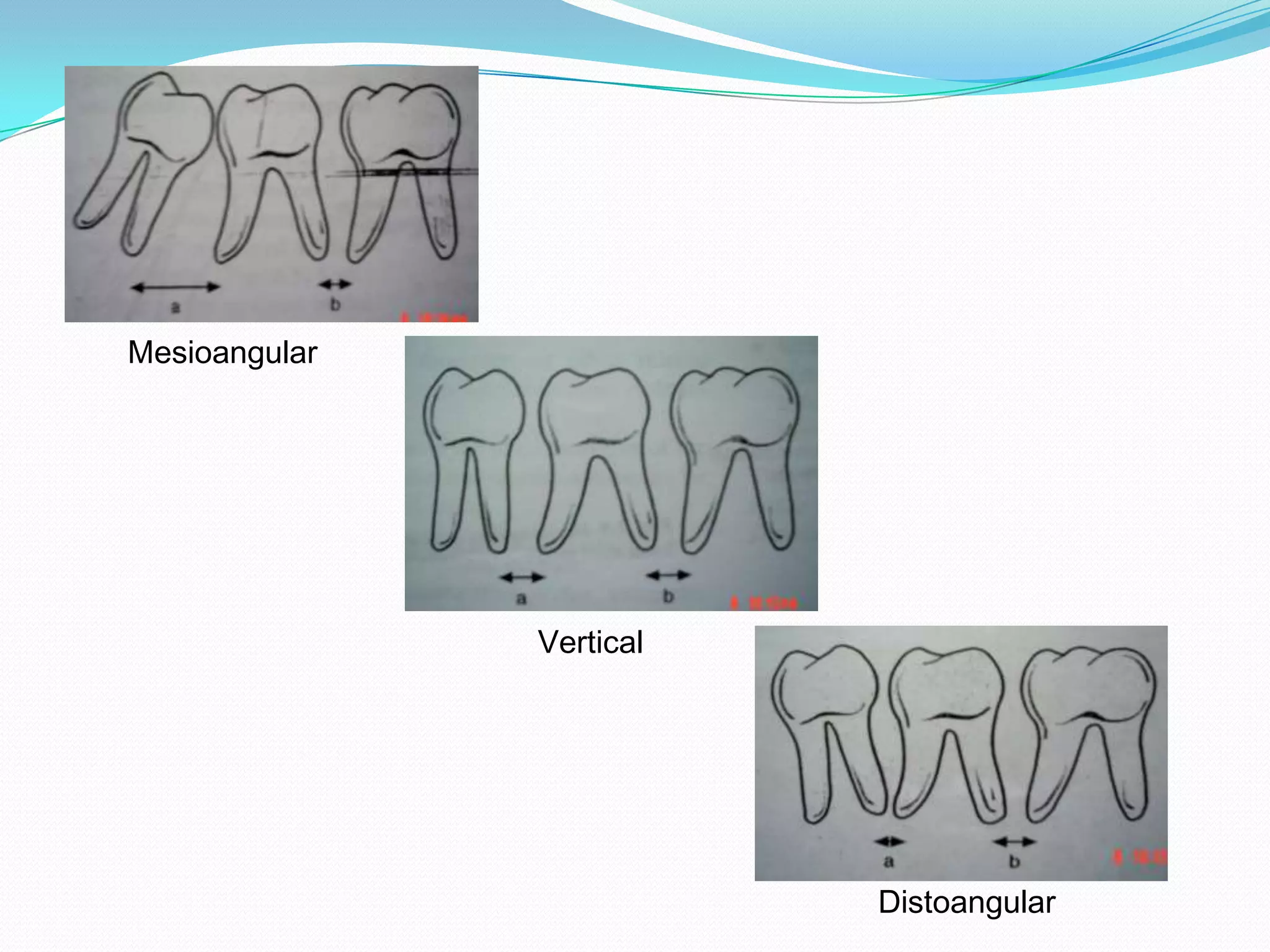 Mandibular 3rd molar impactions | PPTX