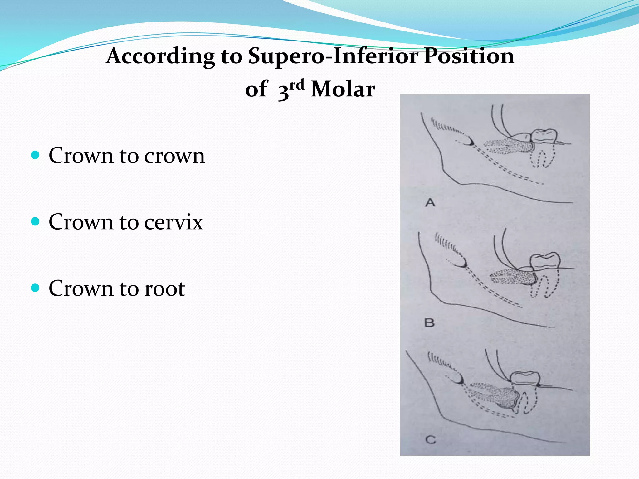 Mandibular 3rd molar impactions | PPTX