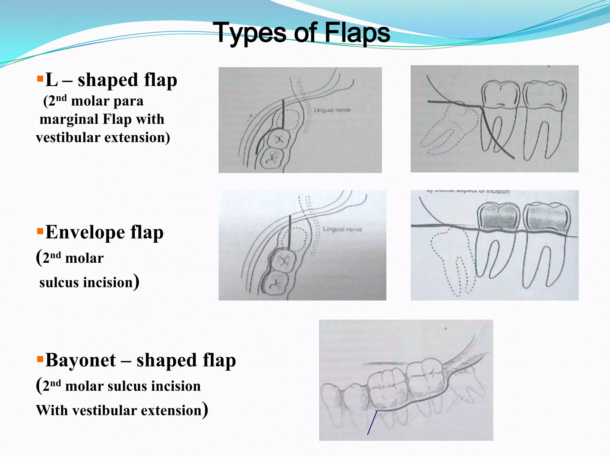 Mandibular 3rd molar impactions | PPTX
