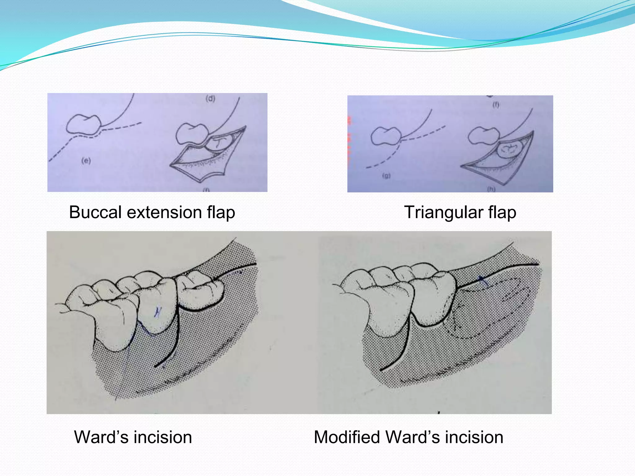 Mandibular 3rd molar impactions | PPTX