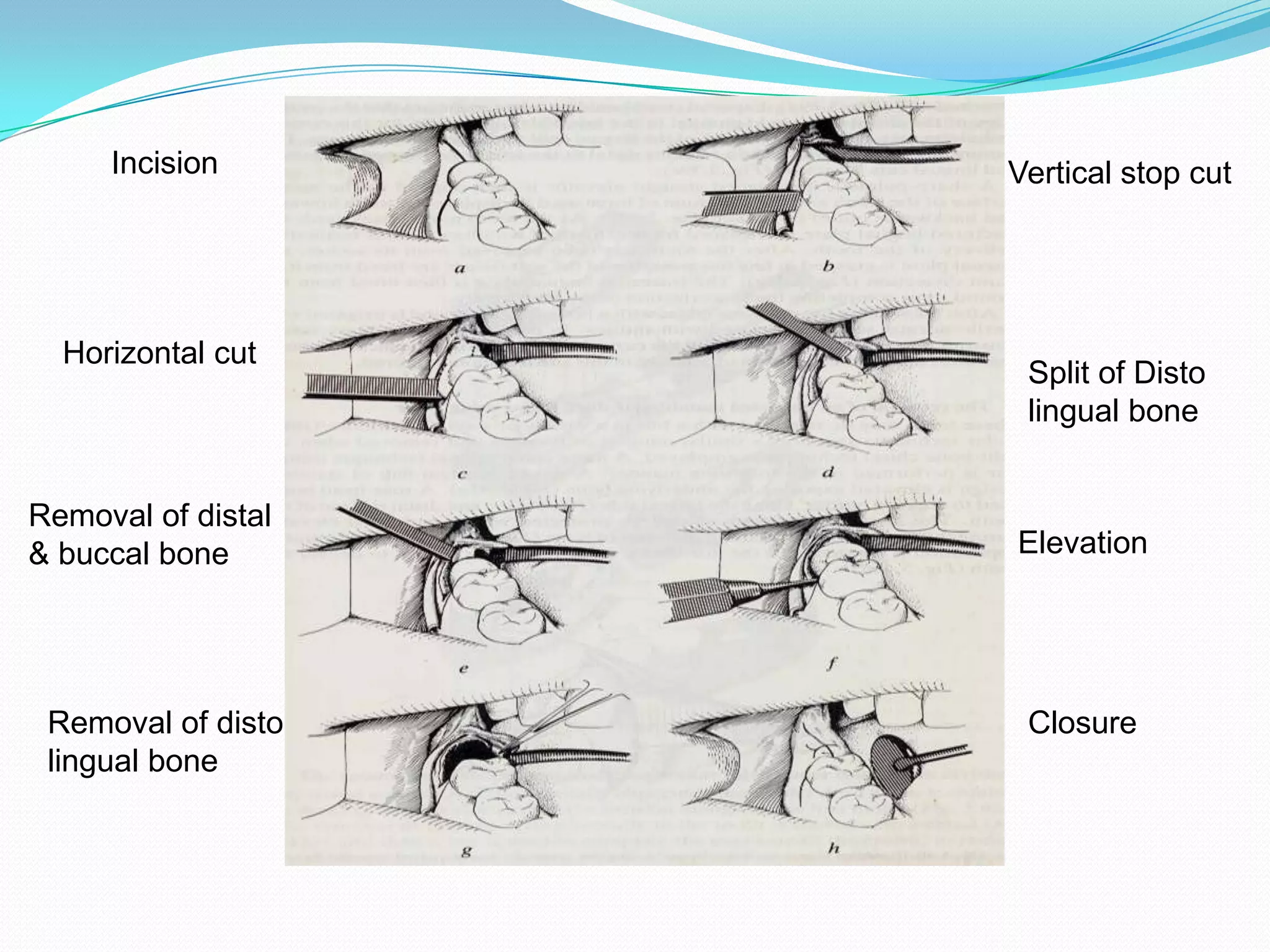 Mandibular 3rd molar impactions | PPTX