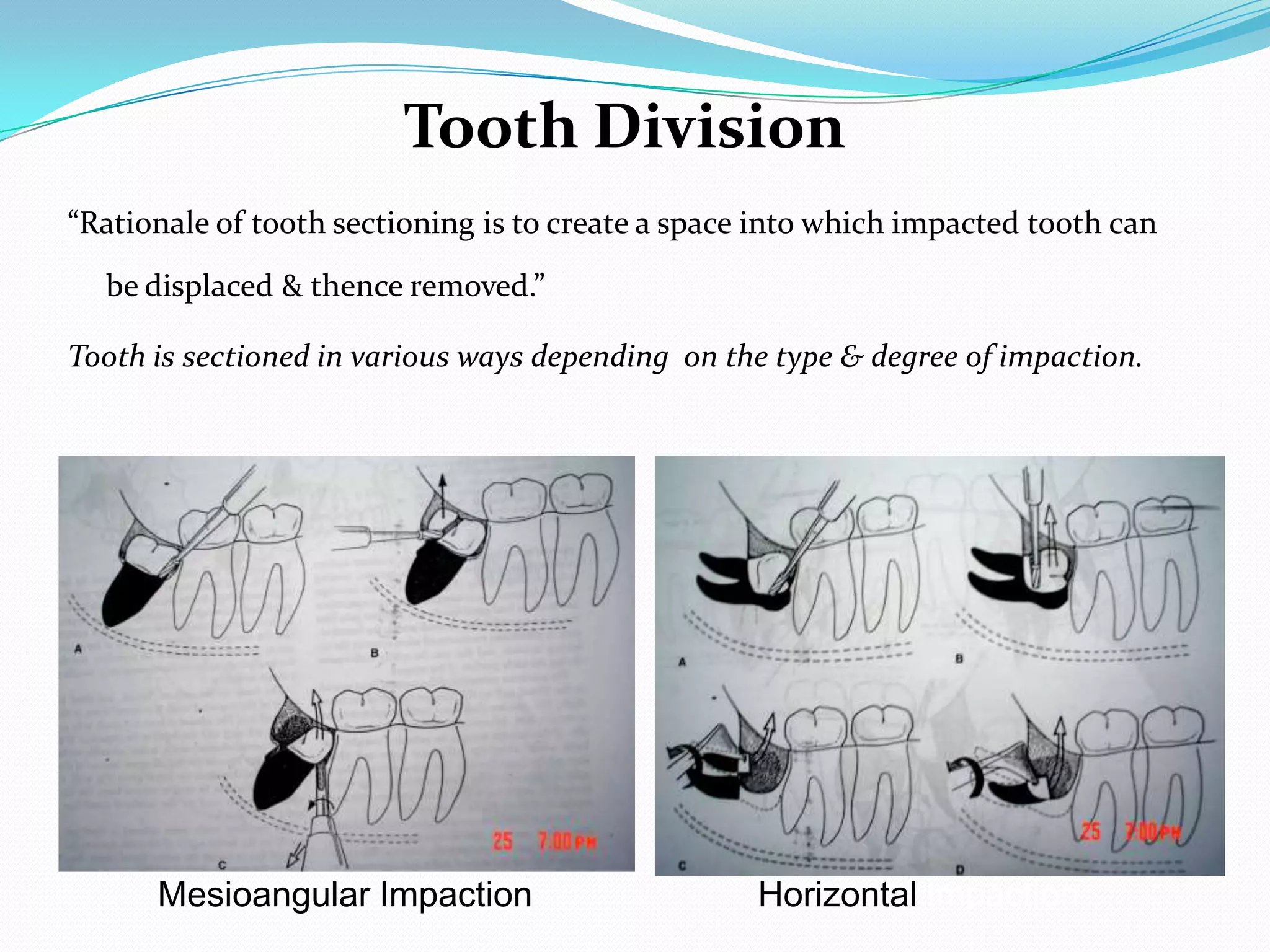 Mandibular 3rd molar impactions | PPTX