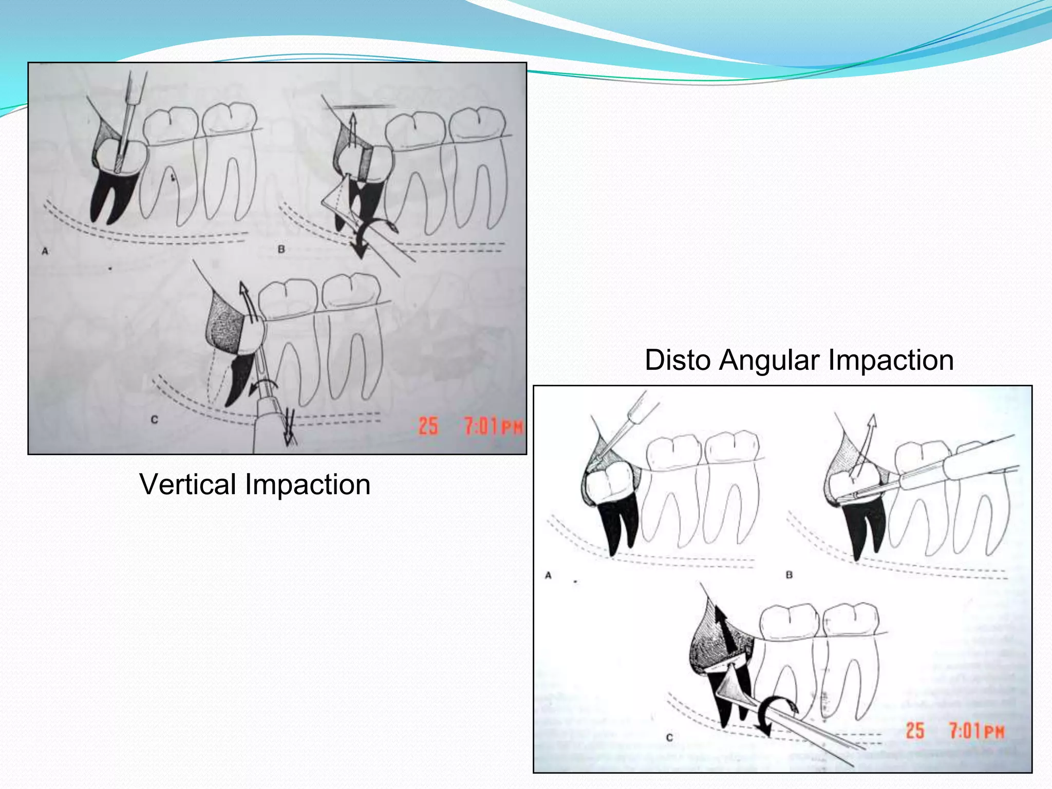 Mandibular 3rd molar impactions | PPTX