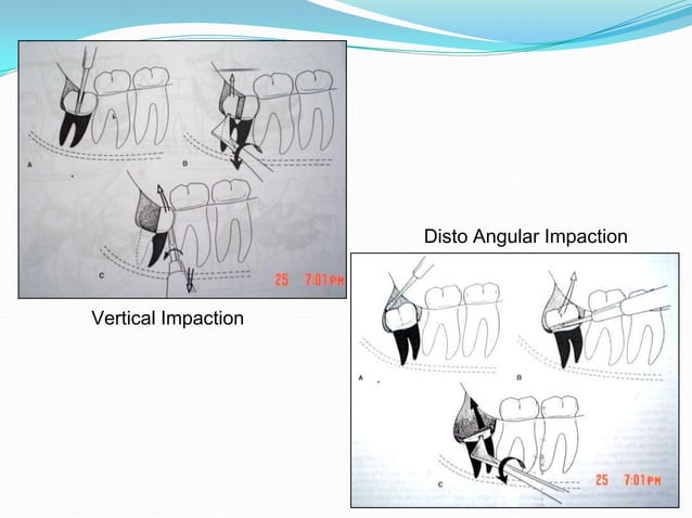 Mandibular 3rd molar impactions | PPTX | Ear, Nose and Throat ...