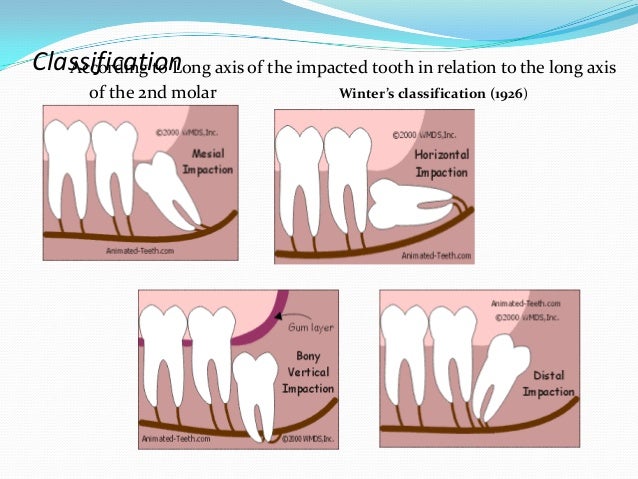 Mandibular 3rd Molar Impactions