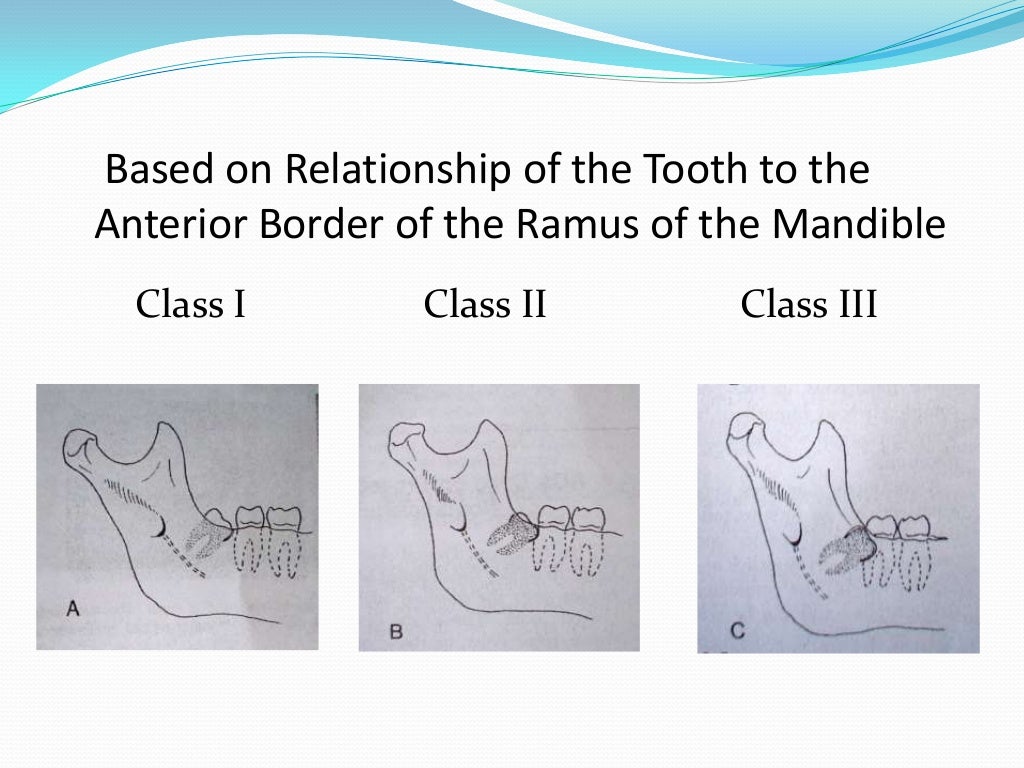 Mandibular 3rd molar impactions