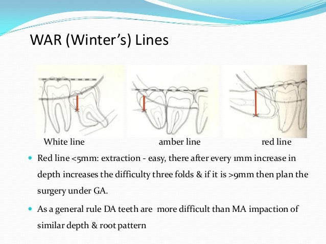 Mandibular 3rd molar impactions
