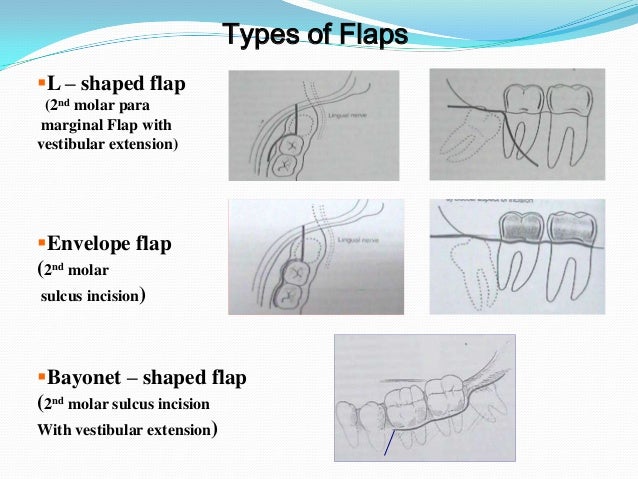 Mandibular 3rd molar impactions