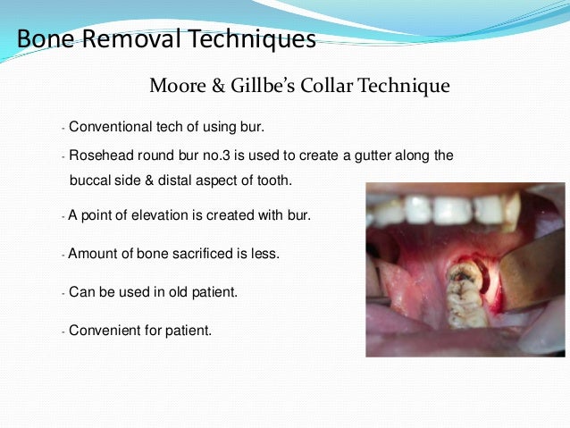 Mandibular 3rd molar impactions