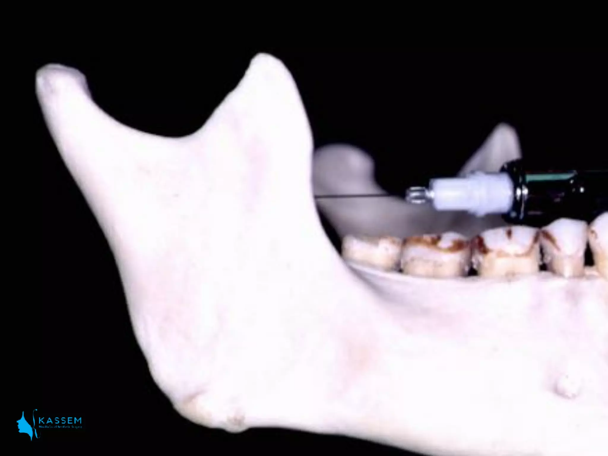 Mandibular anaesthesia | PDF