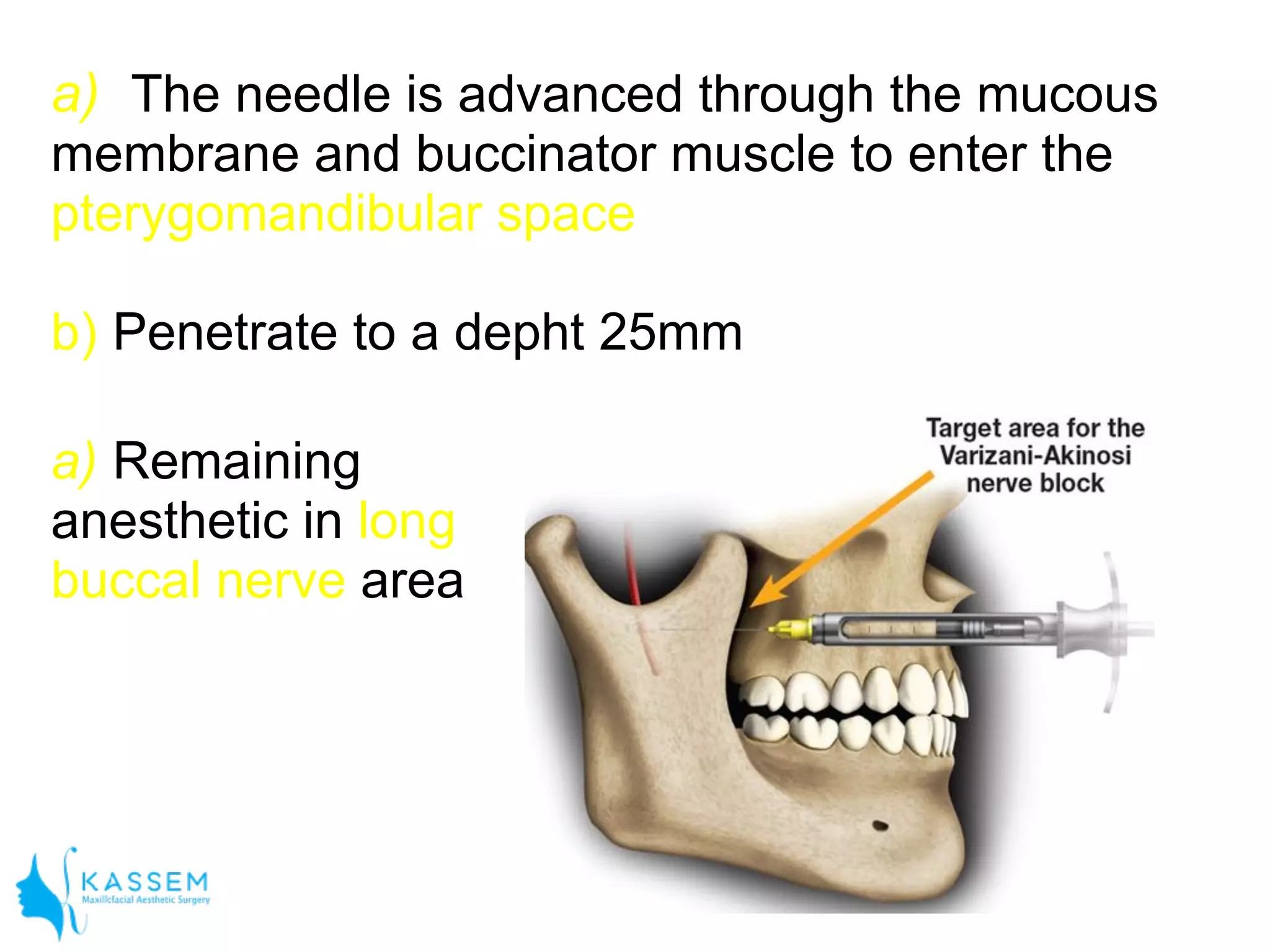 Mandibular anaesthesia | PDF