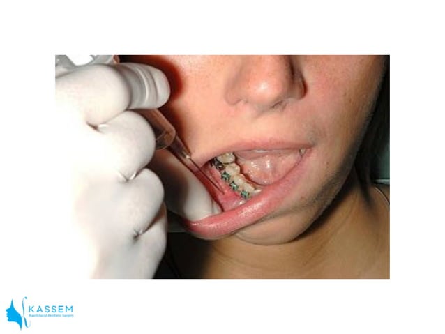 Mandibular anaesthesia | PDF