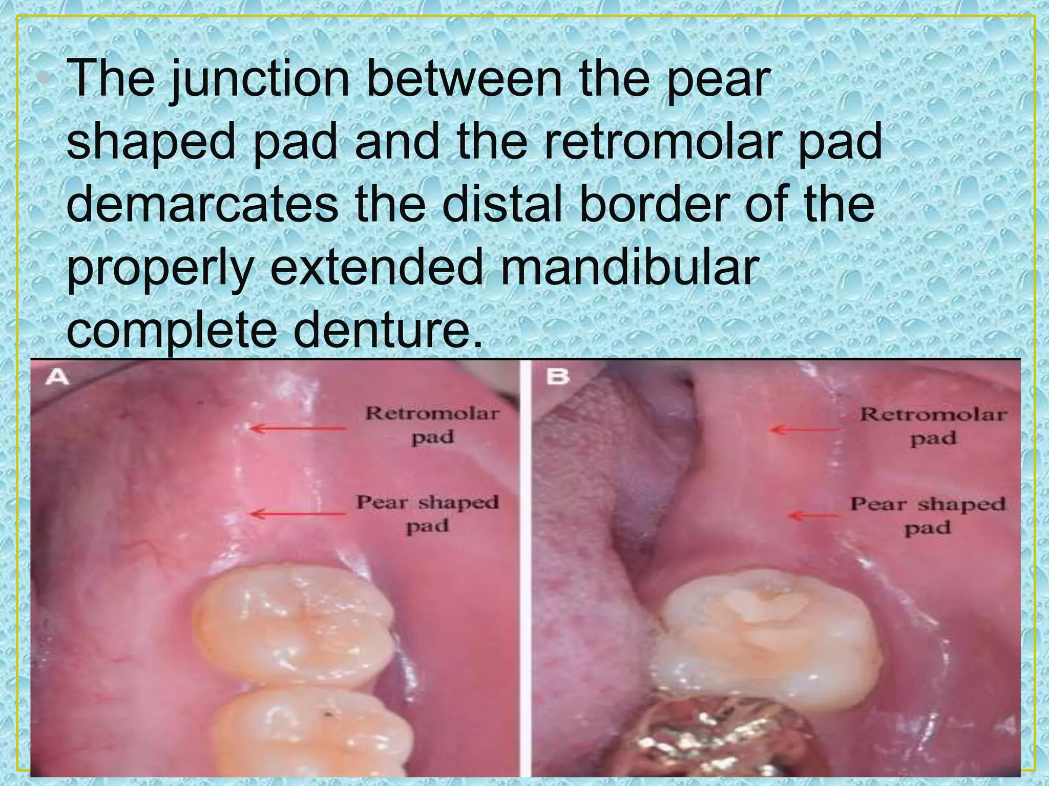 Anatomical Landmarks Mandibular prosthodontics | PPTX