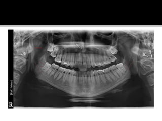 Mandibular anatomy for dental implant | PPTX