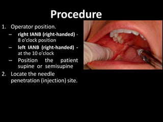 Mandibular anesthesia | PPTX