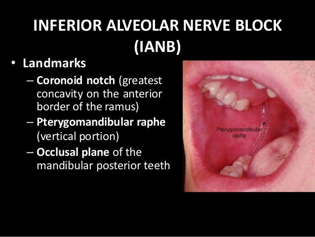 Mandibular anesthesia