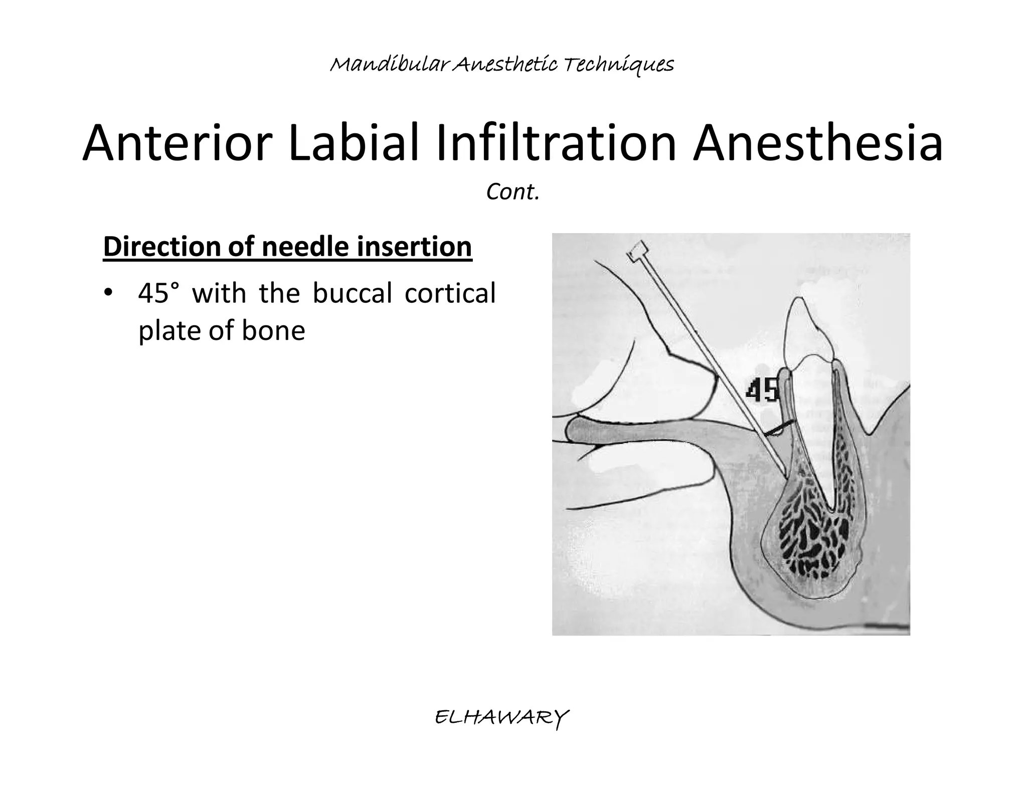 Mandibular anesthetic techniques | PDF