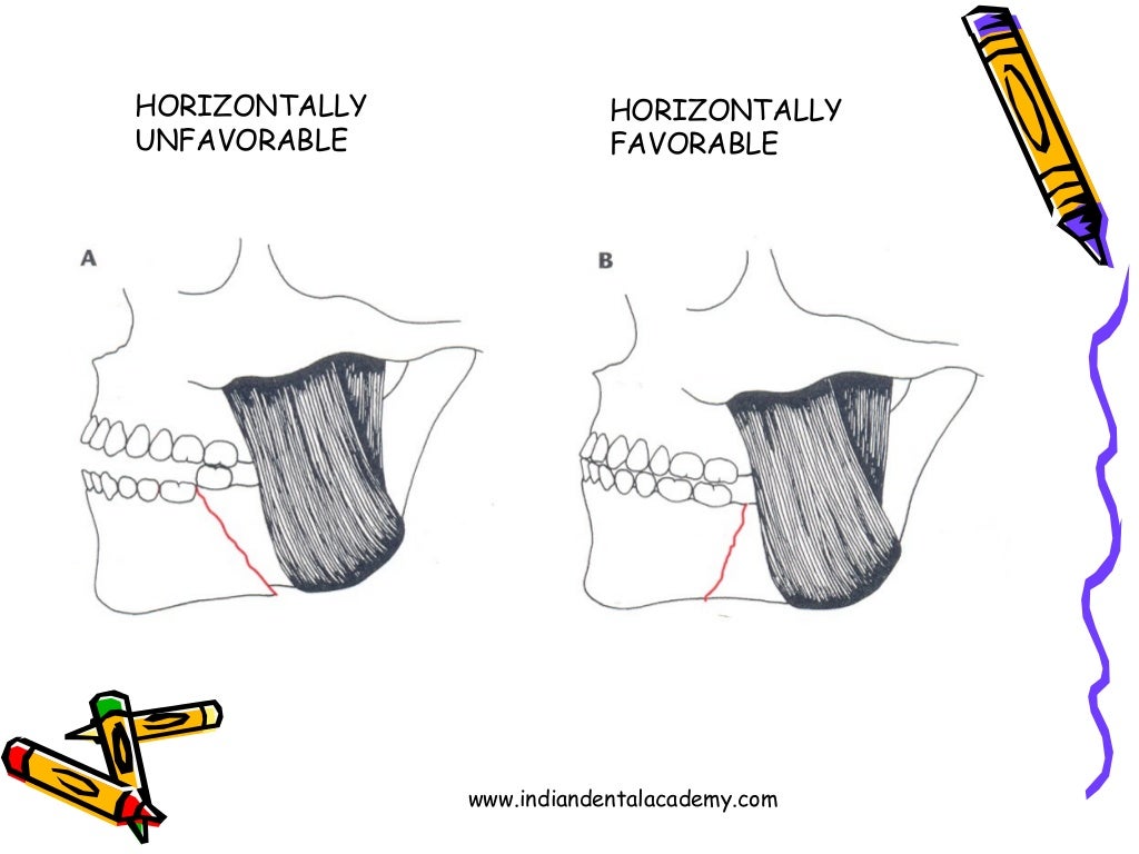 Mandibular angle fractures / /certified fixed orthodontic courses by ...