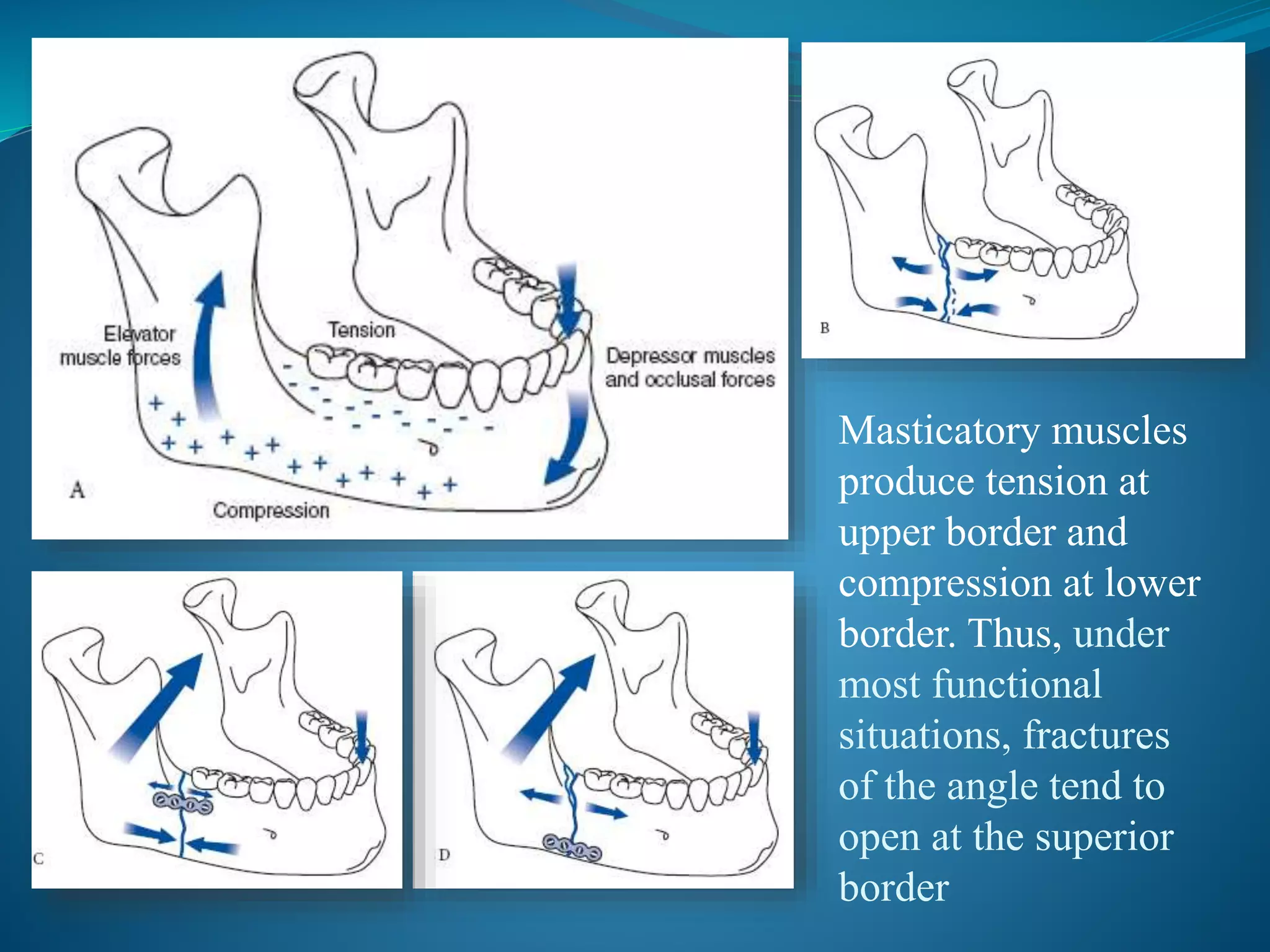 Mandibular Angle Fractures | PPTX