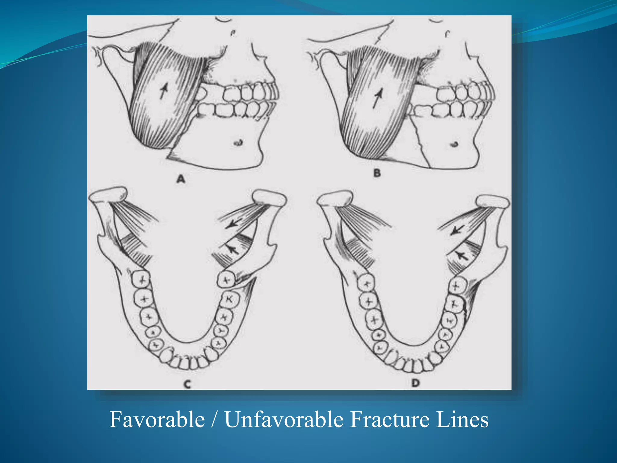 Mandibular Angle Fractures | PPTX