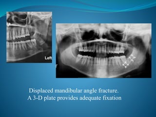 Mandibular Angle Fractures | PPTX