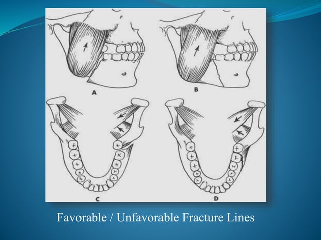 Mandibular Angle Fractures | PPTX | First Aid | Injuries