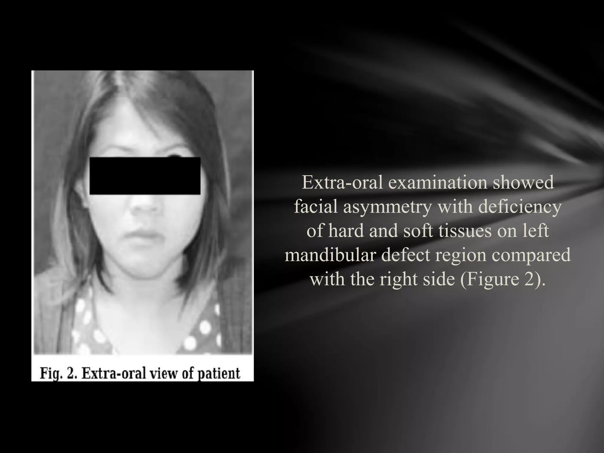 Mandibular defects maxillofacial prosthesis | PPTX