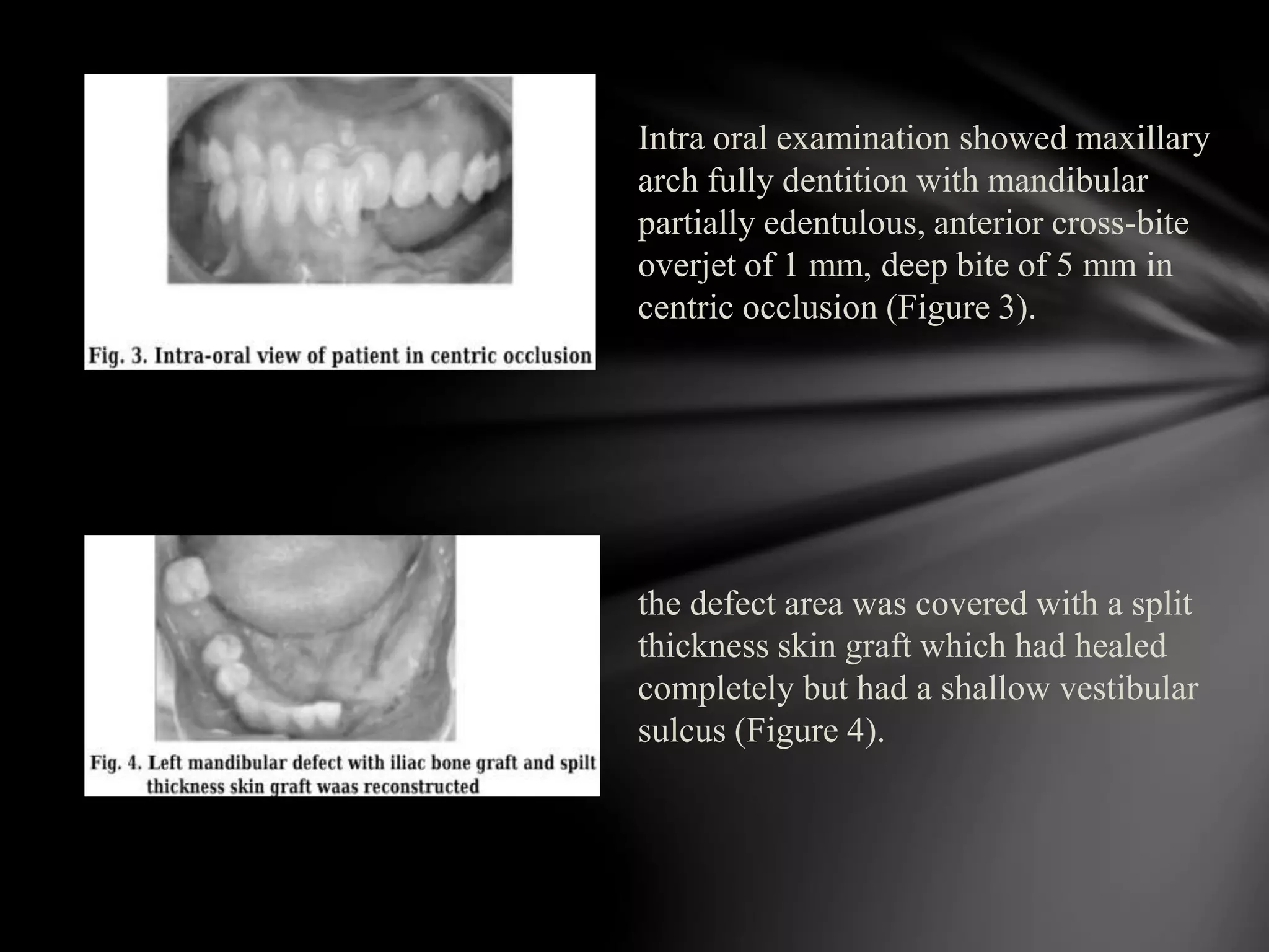 Mandibular defects maxillofacial prosthesis | PPTX