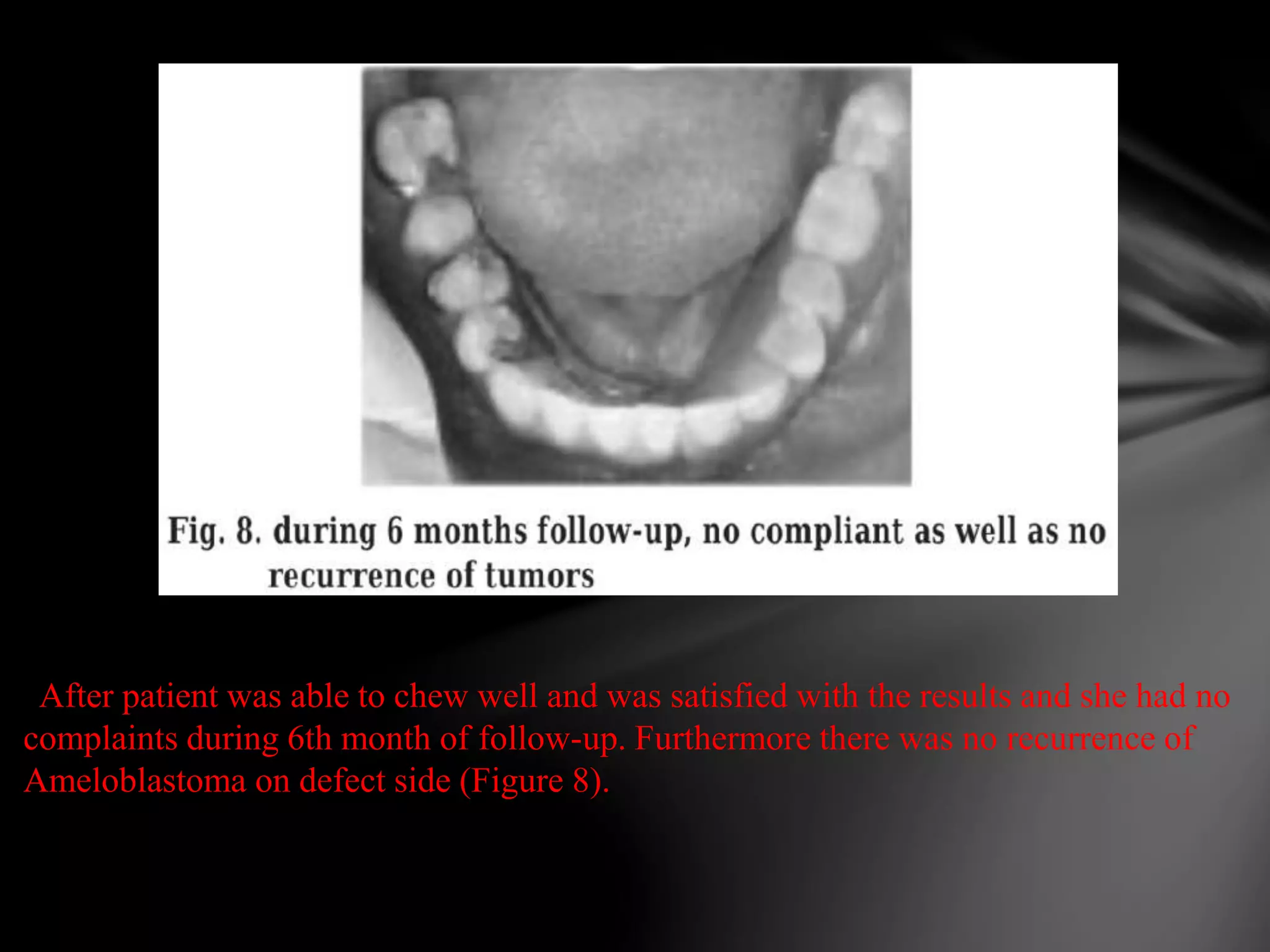 Mandibular defects maxillofacial prosthesis | PPTX