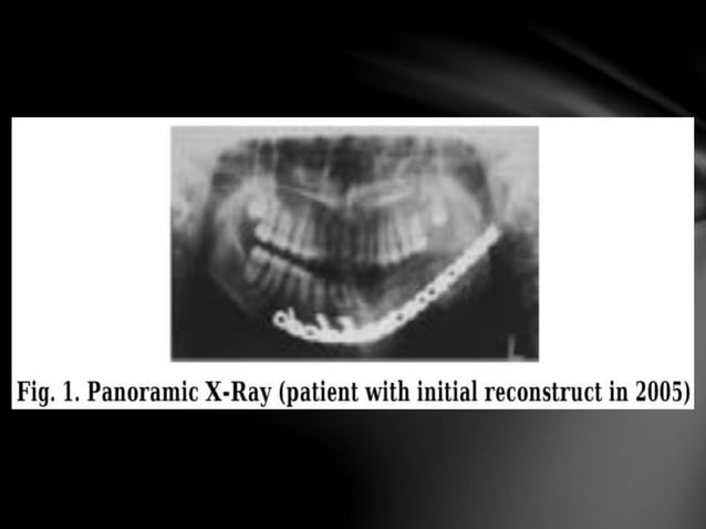 Mandibular defects maxillofacial prosthesis | PPTX | Dental Health ...