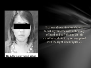 Mandibular defects maxillofacial prosthesis | PPTX