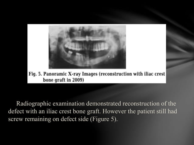 Mandibular defects maxillofacial prosthesis | PPTX | Dental Health ...