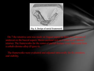 Mandibular defects maxillofacial prosthesis | PPTX