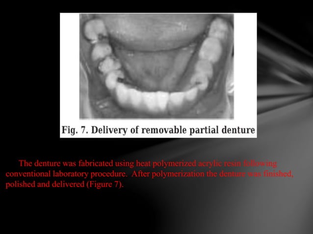 Mandibular defects maxillofacial prosthesis | PPTX | Dental Health ...