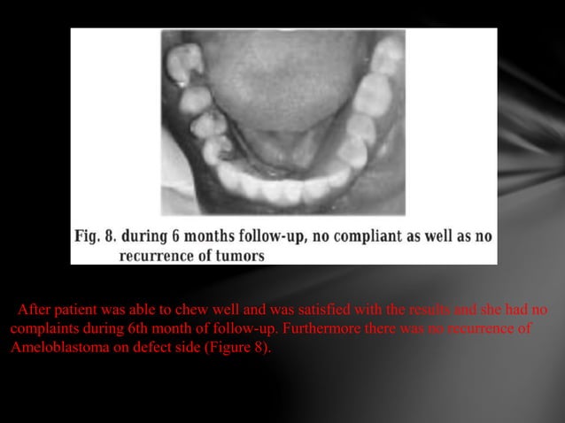 Mandibular defects maxillofacial prosthesis | PPTX | Dental Health ...