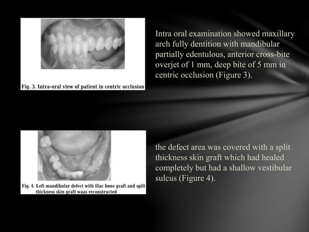 Mandibular defects maxillofacial prosthesis