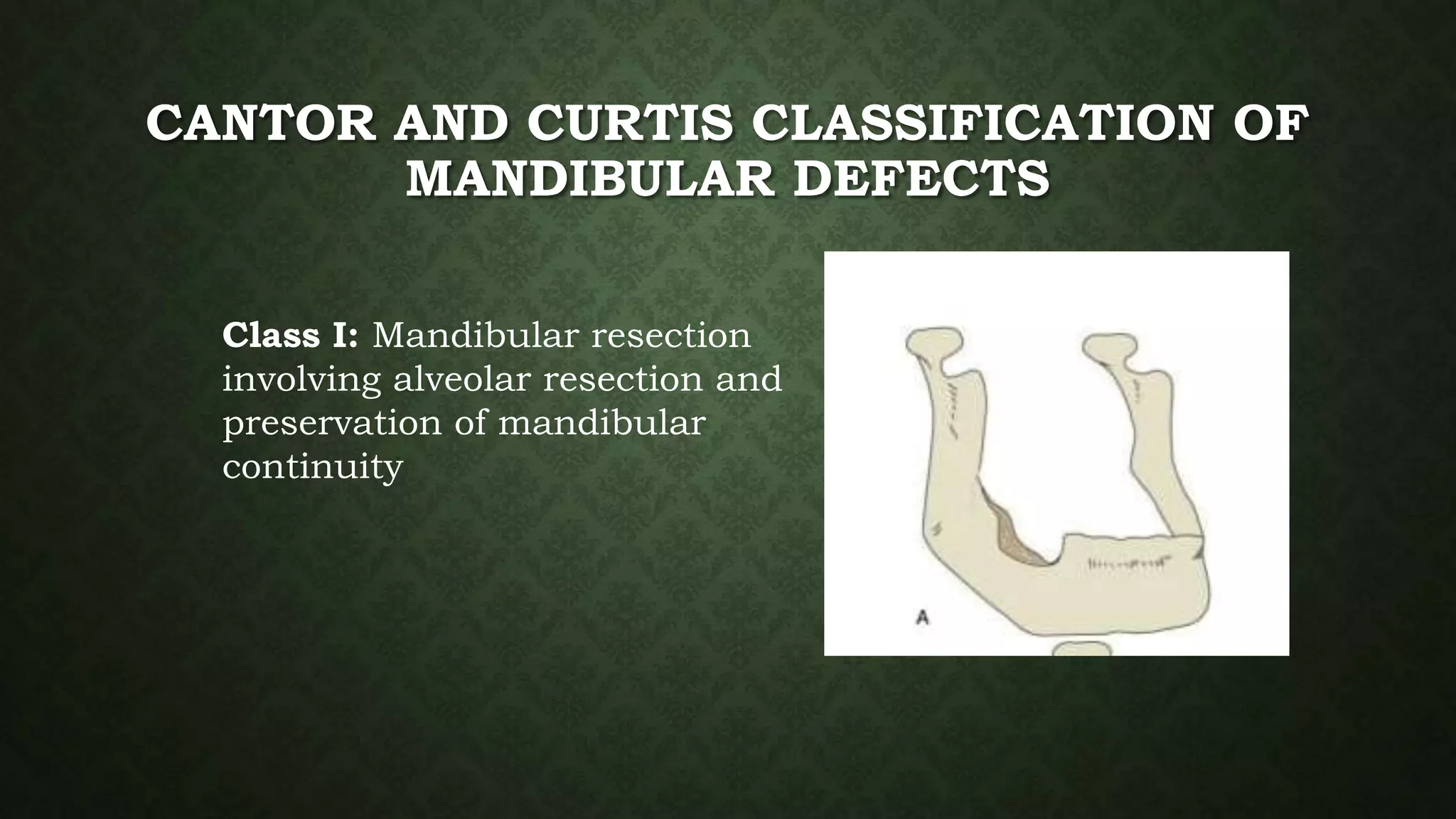 MANDIBULAR_DEFECTS( SEMI 4).pptx | Dental Health | Diseases and Conditions