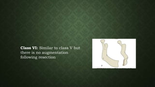 MANDIBULAR_DEFECTS( SEMI 4).pptx