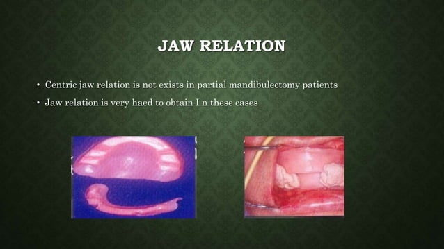 MANDIBULAR_DEFECTS( SEMI 4).pptx | Dental Health | Diseases and Conditions