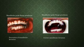MANDIBULAR_DEFECTS( SEMI 4).pptx