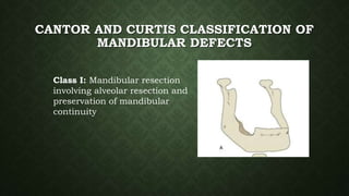 MANDIBULAR_DEFECTS( SEMI 4).pptx
