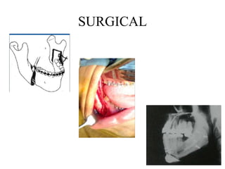 Mandibular Deformities & their Management | PPTX