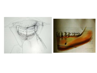 Mandibular Deformities & their Management | PPTX