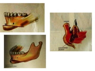 Mandibular Deformities & their Management | PPTX